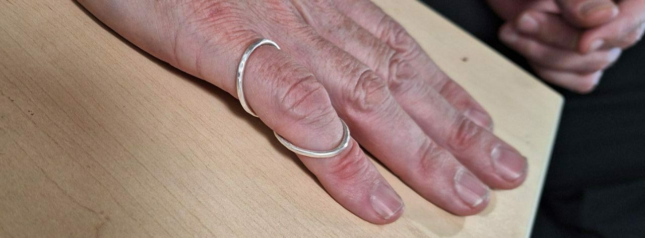 Swan Neck Deformity: Managing it with Orthopedic Silver Ring Splints ...